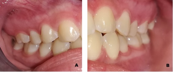 Paramolares bilaterales maxilares no erupcionados y su abordaje ...