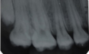 Paramolares bilaterales maxilares no erupcionados y su abordaje ...