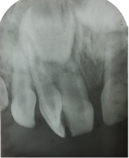 Paramolares bilaterales maxilares no erupcionados y su abordaje ...