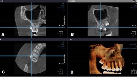 Paramolares bilaterales maxilares no erupcionados y su abordaje ...