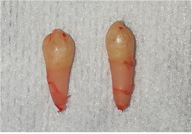 Paramolares bilaterales maxilares no erupcionados y su abordaje ...