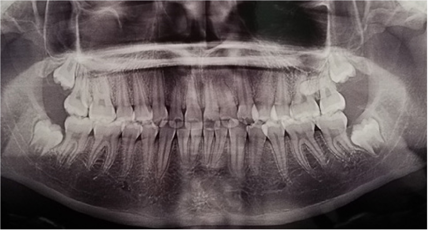 Paramolares bilaterales maxilares no erupcionados y su abordaje ...